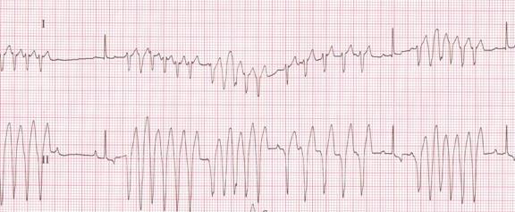 Tachycardia (Rapid Heart Beat) in Dogs – Symptoms, Diagnosis and Treat ...
